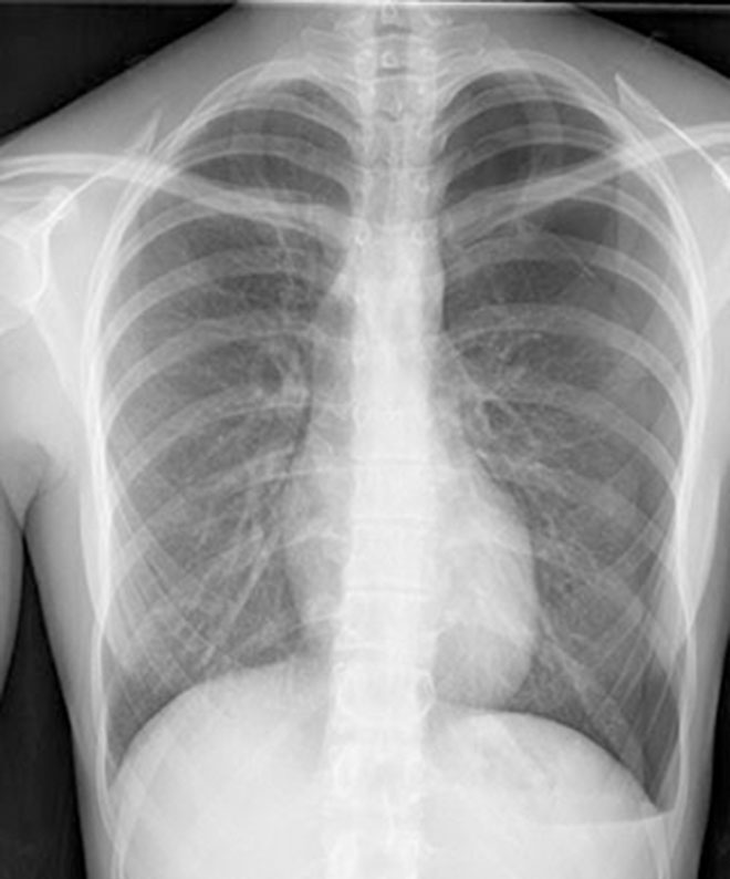 Spontaneous Pneumothorax - Western Toronto Thoracic Associates